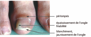 Examen du pied : « du cor au mal perforant » | Formation Médicale ...